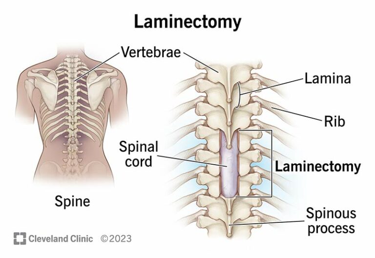 Laminectomia: Cos'è, Procedura, Recupero E Complicanze - SFOMC