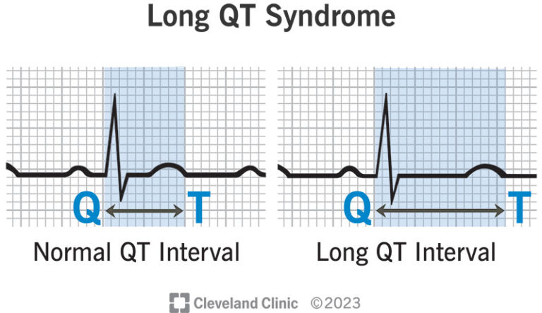 Sindrome Del QT Lungo: Sintomi E Trattamento - SFOMC
