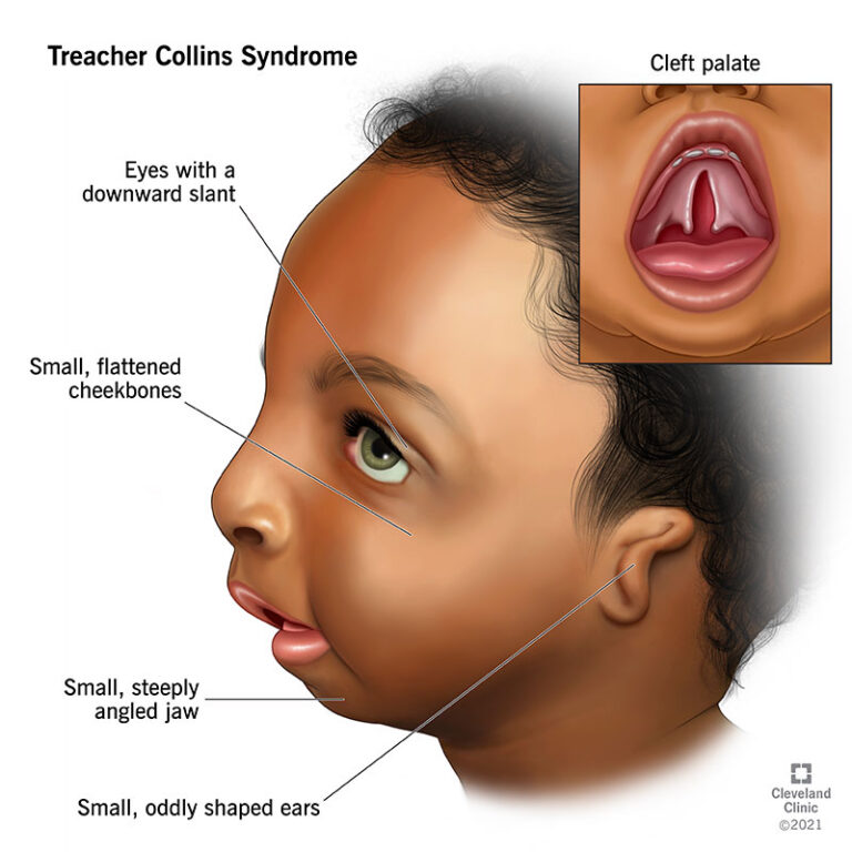 Sindrome Di Treacher Collins: Sintomi, Cause E Trattamento - SFOMC