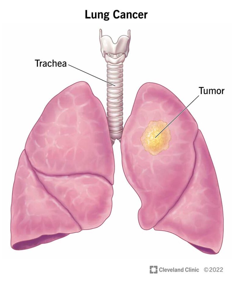 Cancro Al Polmone: Tipi, Stadi, Sintomi, Diagnosi E Trattamento - SFOMC Cancro Al Polmone: Tipi, Stadi, Sintomi, Diagnosi E Trattamento - SFOMC