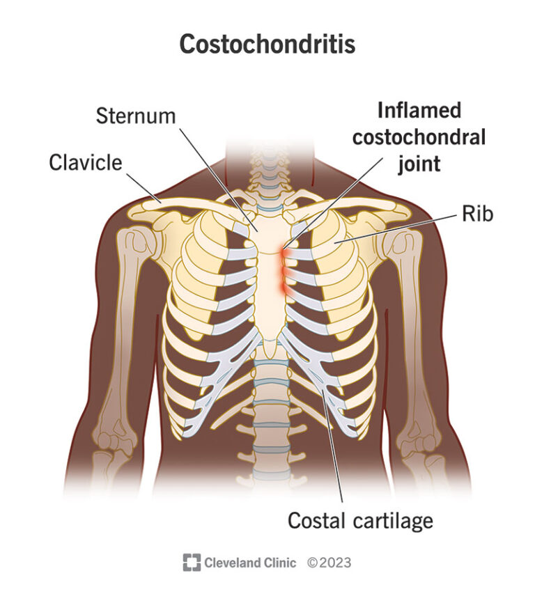 Costocondrite: Cos'è, Cause, Domande Frequenti E Trattamento - SFOMC