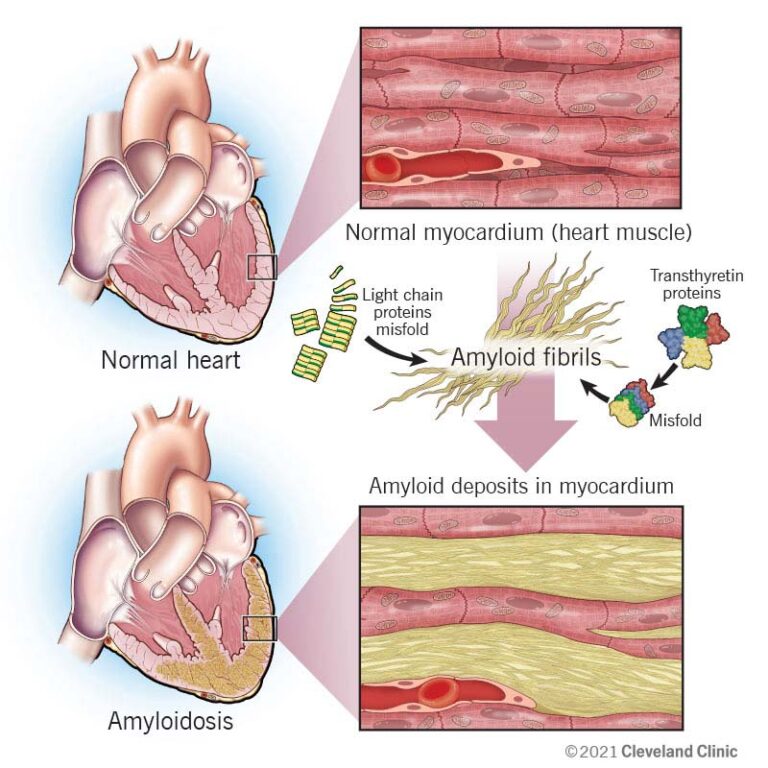 Amiloidosi Cardiaca: Cause, Sintomi E Trattamento - SFOMC
